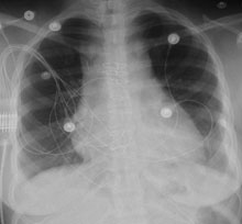 Thoracic Imaging: Chest X-Ray | Cleveland Clinic
