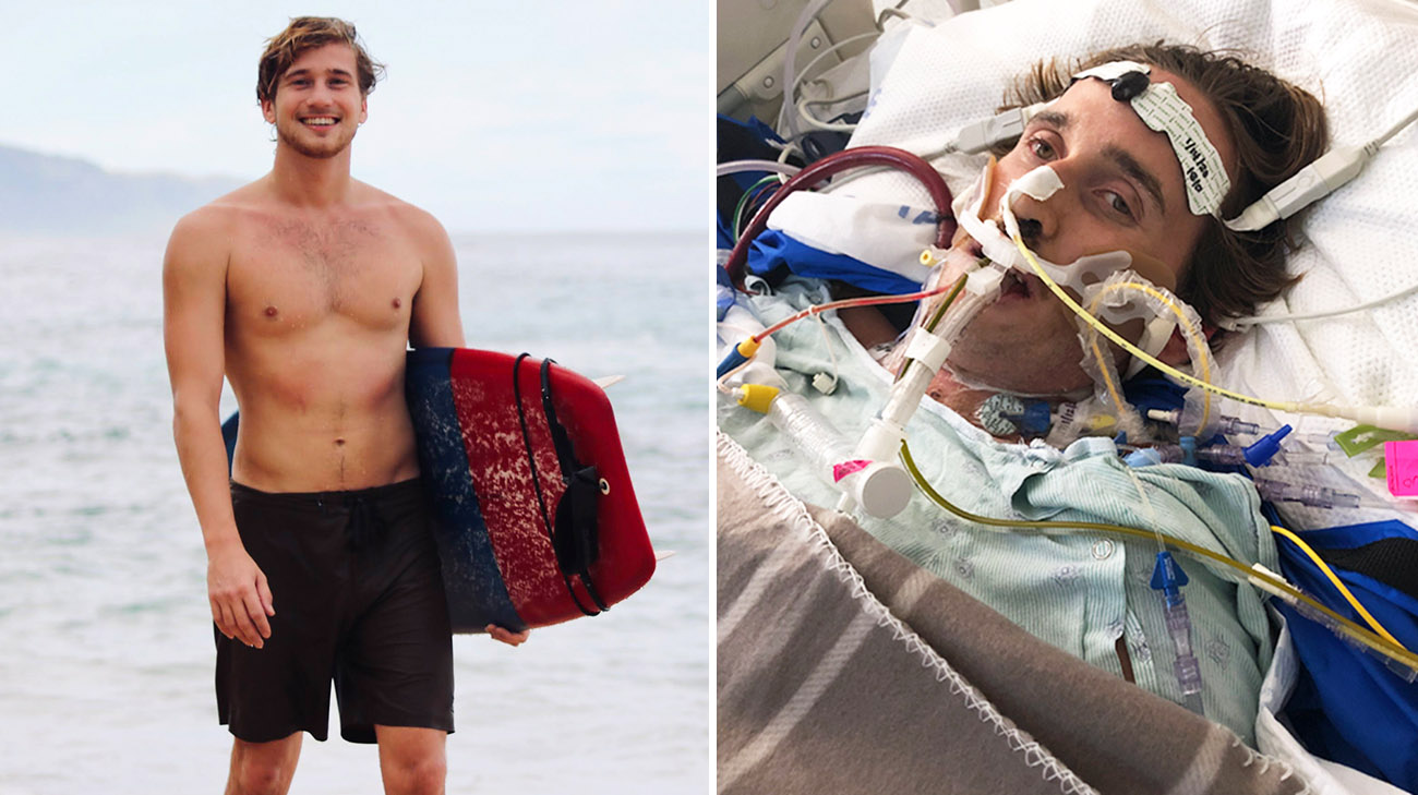 Young Surfer Loses Lung and Leg From Infection Caused by Flu