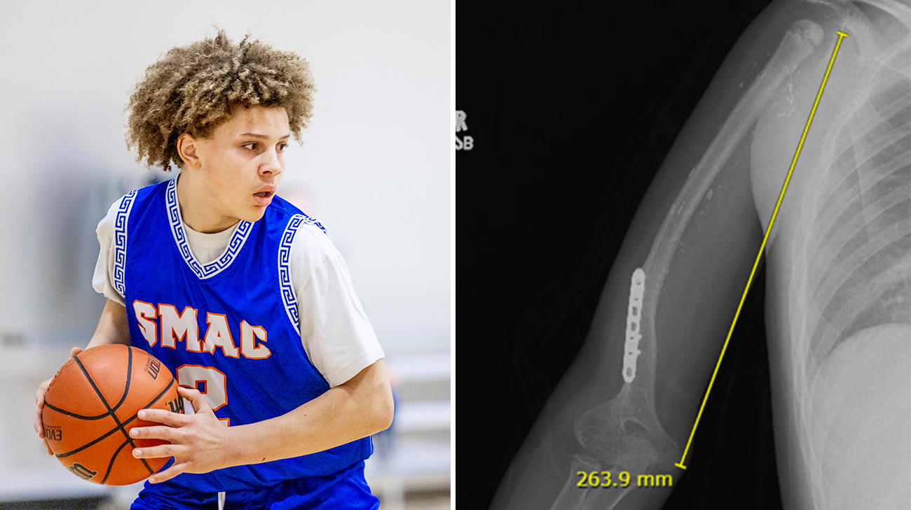 Teen Athlete Has Leg Bone Transplanted Into Arm To Treat Bone Cancer